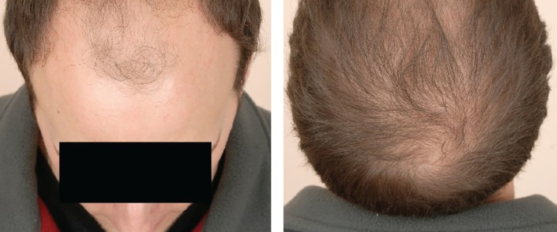 Recognizing Hormonal Changes and Male Pattern Baldness