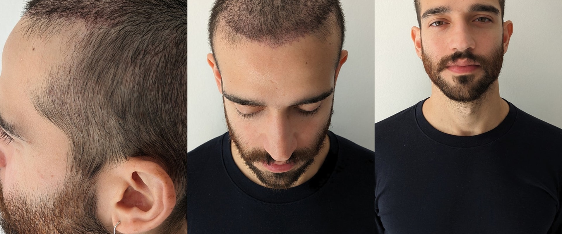 Hair Transplants for Permanent Hair Restoration: A Comprehensive Guide